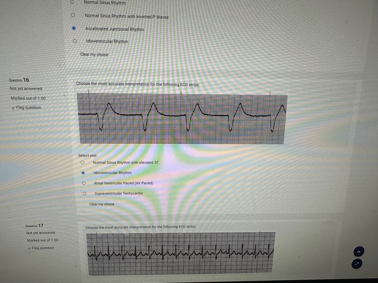 Solved Normal Sinus Rhythm Normal Sinus Rhythm with Inverted | Chegg.com
