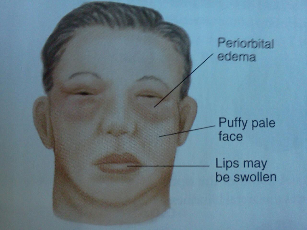 Periorbital Edema Nephrotic Syndrome