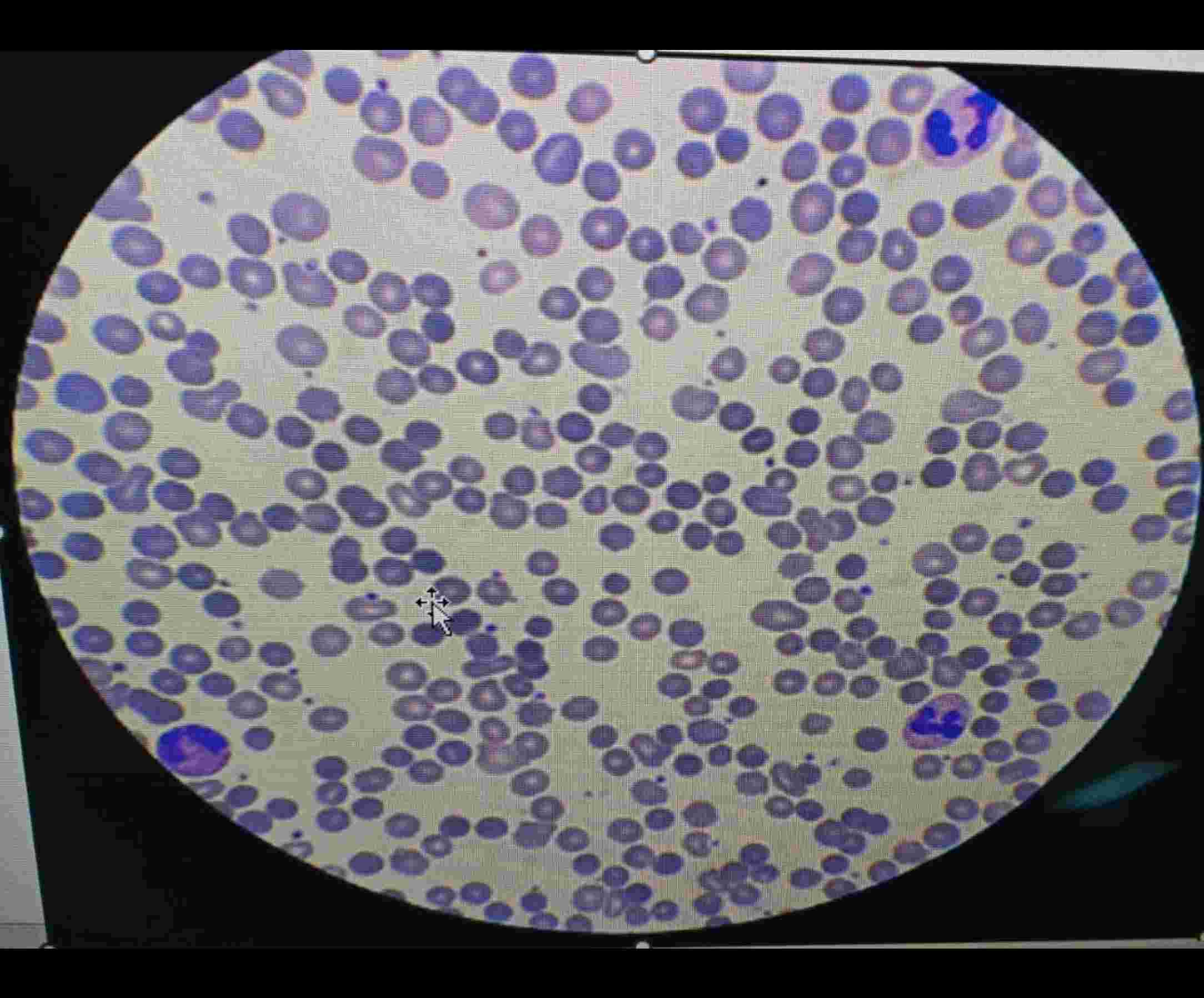 Solved Explain the blood film morphology of the picture | Chegg.com
