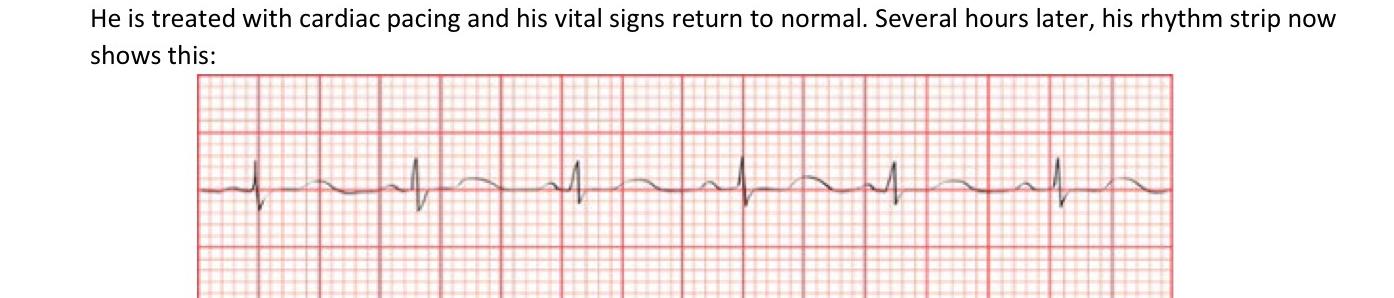 Solved It seems that a PVC landed on a QT interval and | Chegg.com