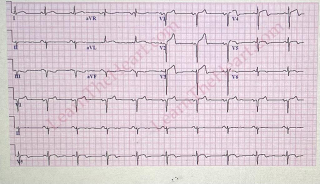 please indicate the rate, axis , degrees, and rhythm | Chegg.com