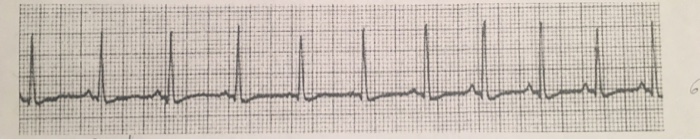 Solved Interpret the following ecg, 6 second strip: Rhythm | Chegg.com
