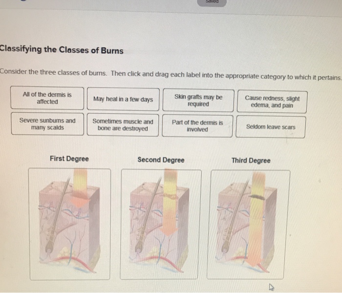 Solved Classifying the Classes of Burns Consider the three | Chegg.com