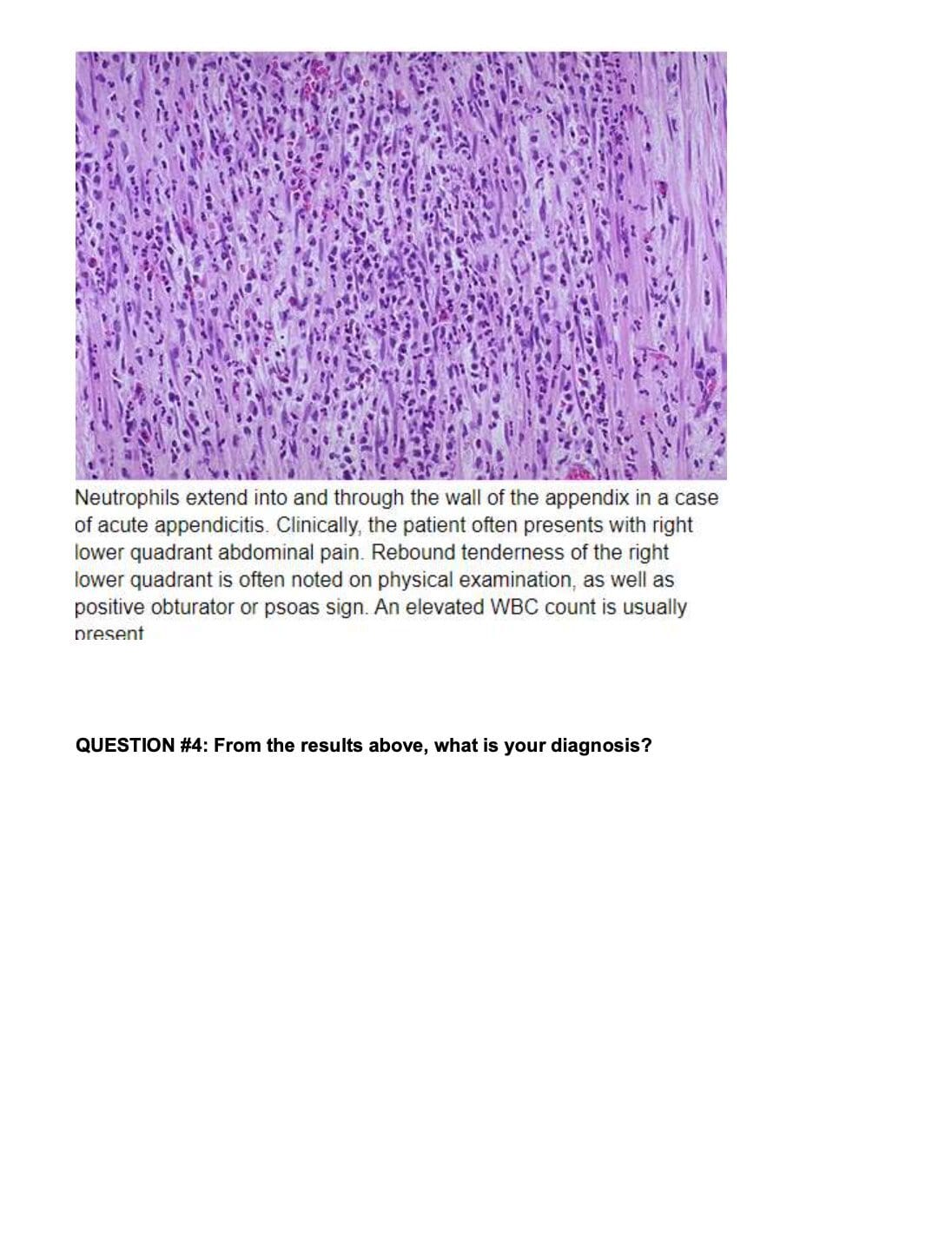 Solved Histology showed: Microscopically, acute appendicitis | Chegg.com