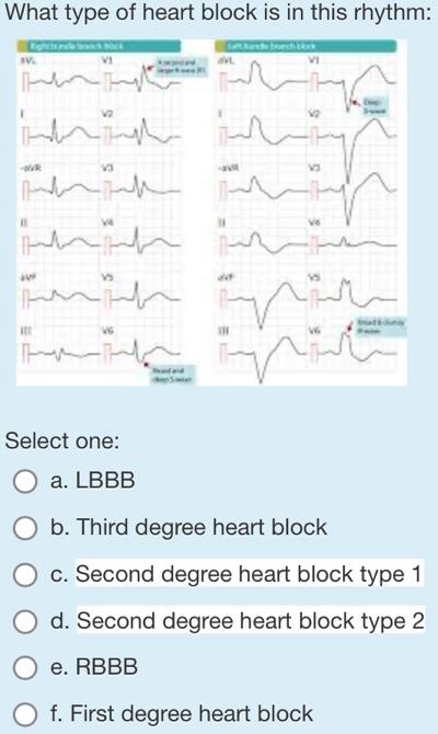 What type of heart block is in this rhythm: Select | Chegg.com