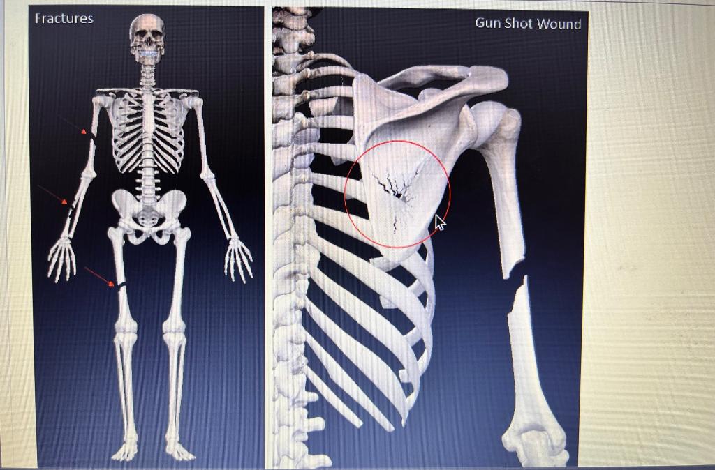 Solved Finally, you assess the whole skeleton for trauma and | Chegg.com