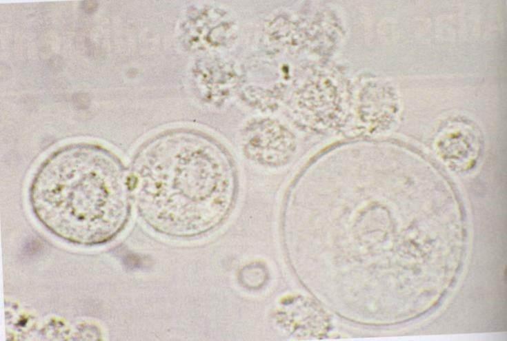 Transitional Renal Epithelial Cells In Urine