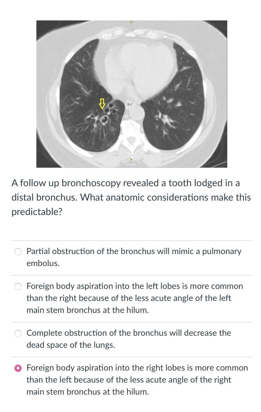 Solved A follow up bronchoscopy revealed a tooth lodged in | Chegg.com