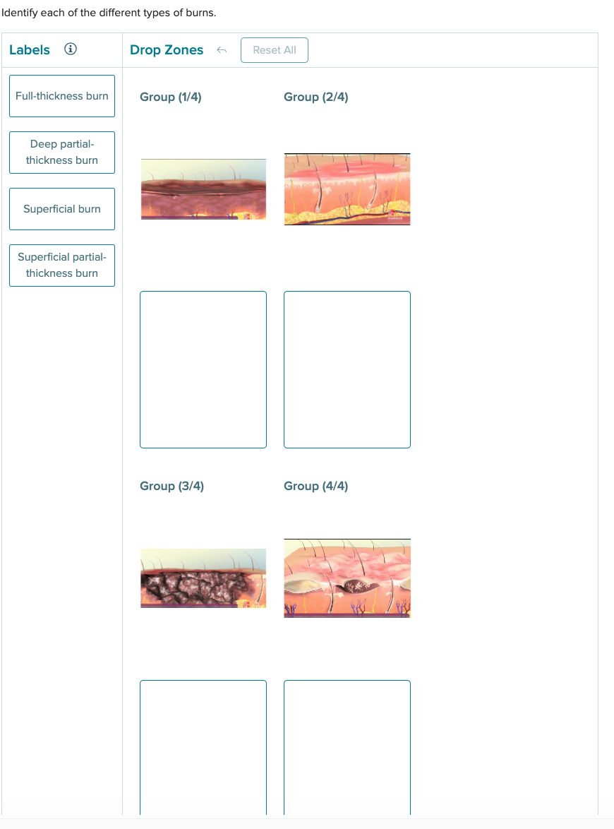 Solved Identify each of the different types of burns. | Chegg.com