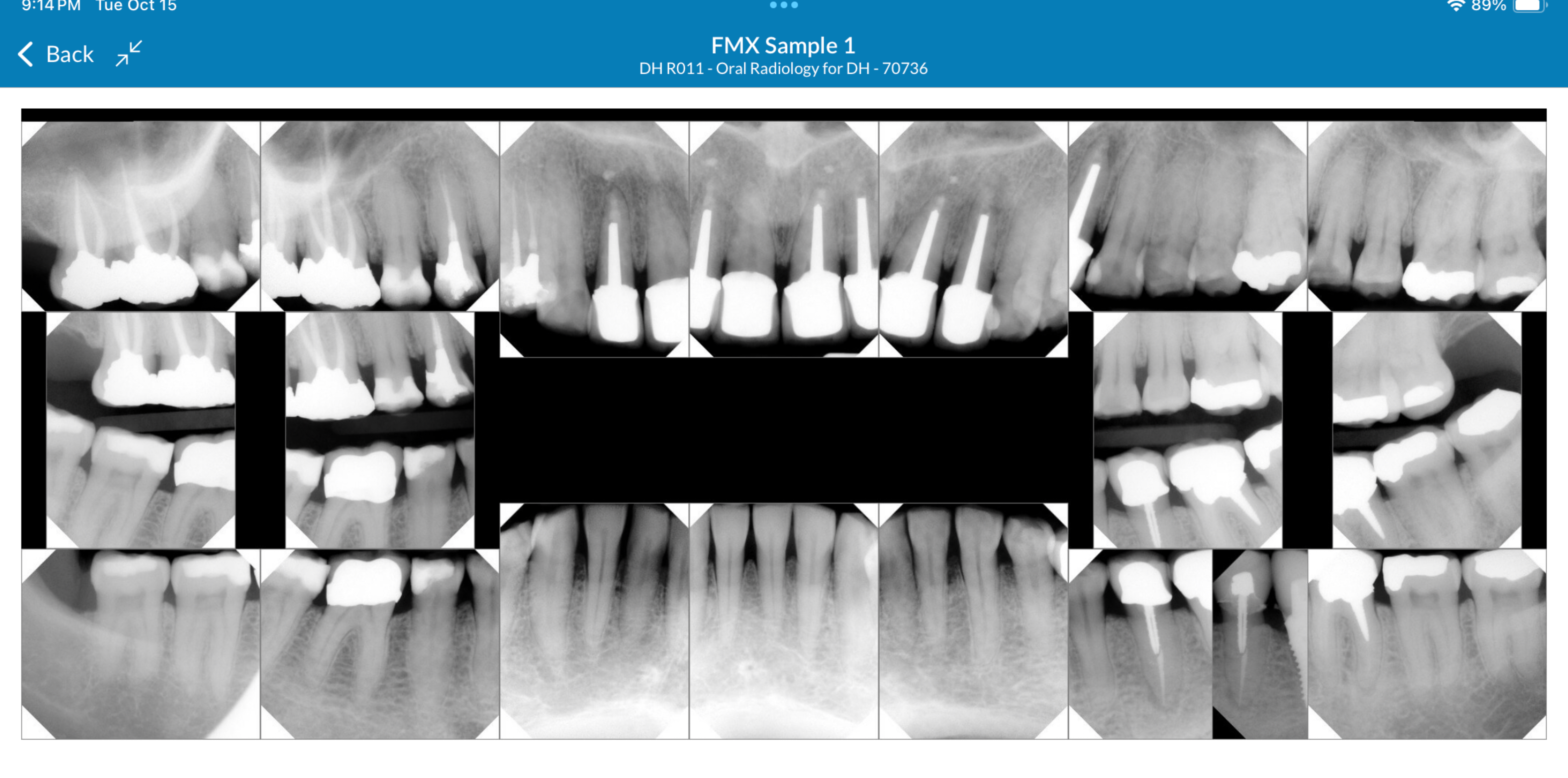 Solved Identify all missing teeth, pathology and | Chegg.com