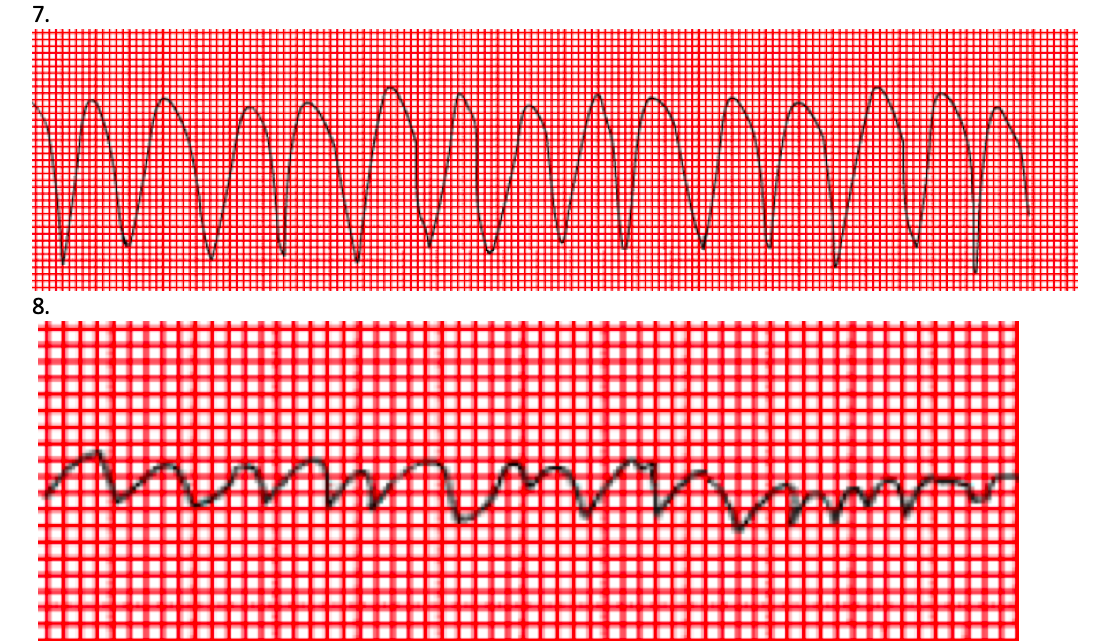 Solved Identify each rhythm and try to identify the | Chegg.com Solved Identify each rhythm and try to identify the | Chegg.com