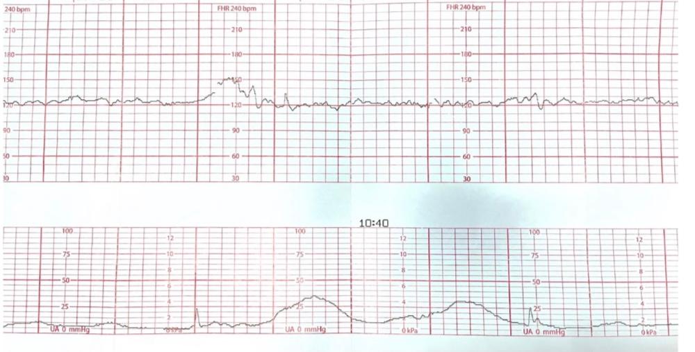 Solved Fetal Monitor Strip Fill in blanks below according to | Chegg.com