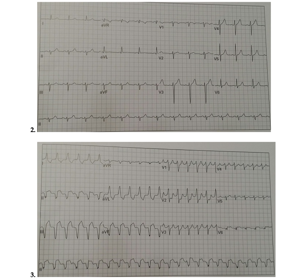 Solved Determine the first 4 steps of EKG analysis on these | Chegg.com