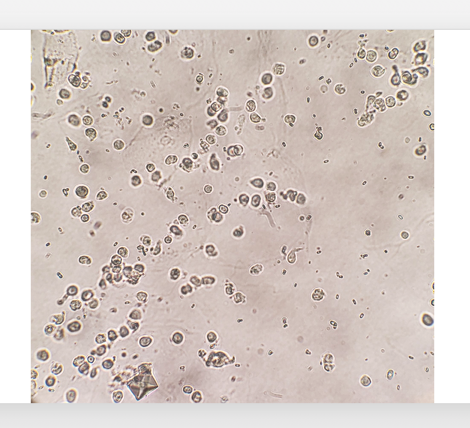 Example: 25-30 RBCs/hpf 1–2 WBCs/hof 1-2 RTEs/hpf | Chegg.com