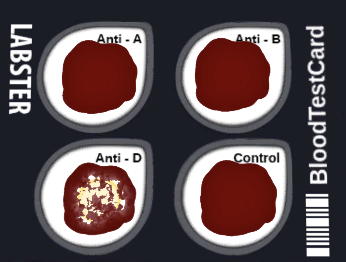 Solved Anti-A LABSTER ОО BloodTestCard ILI Anti-D Anti-A | Chegg.com