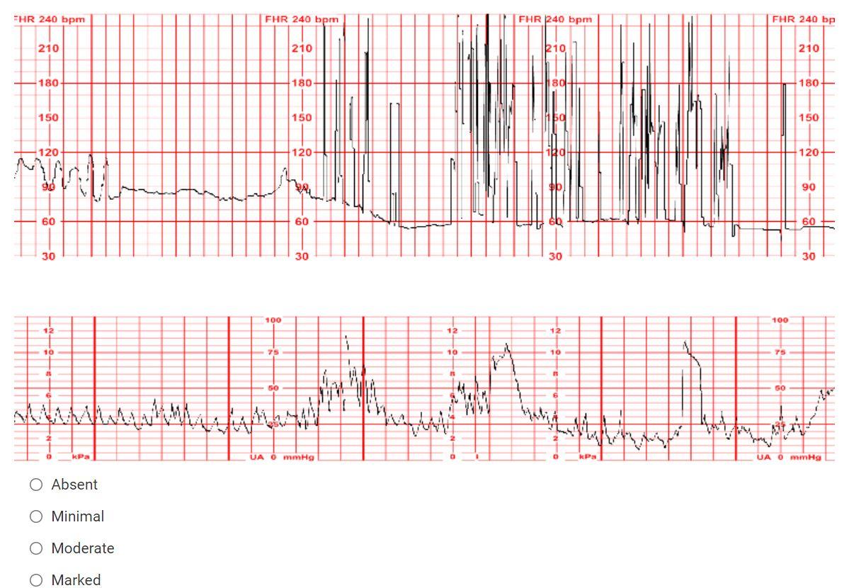 Solved In the EFM strip below, what is the FHR baseline | Chegg.com