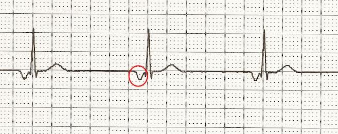 Junctional Rhythm Inverted P Wave