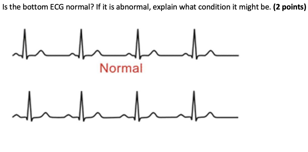 Solved Is the bottom ECG normal? If it is abnormal, explain | Chegg.com
