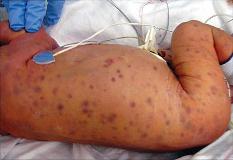 Congenital Toxoplasmosis Rash