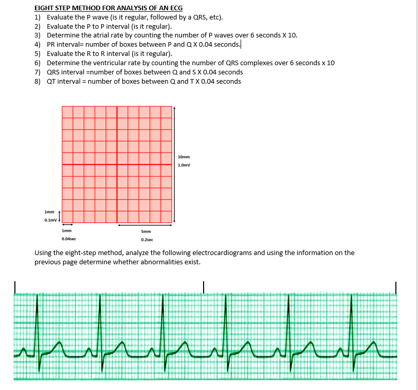 Solved EIGHT STEP METHOD FOR ANALYSIS OF AN ECG 1) Evaluate | Chegg.com