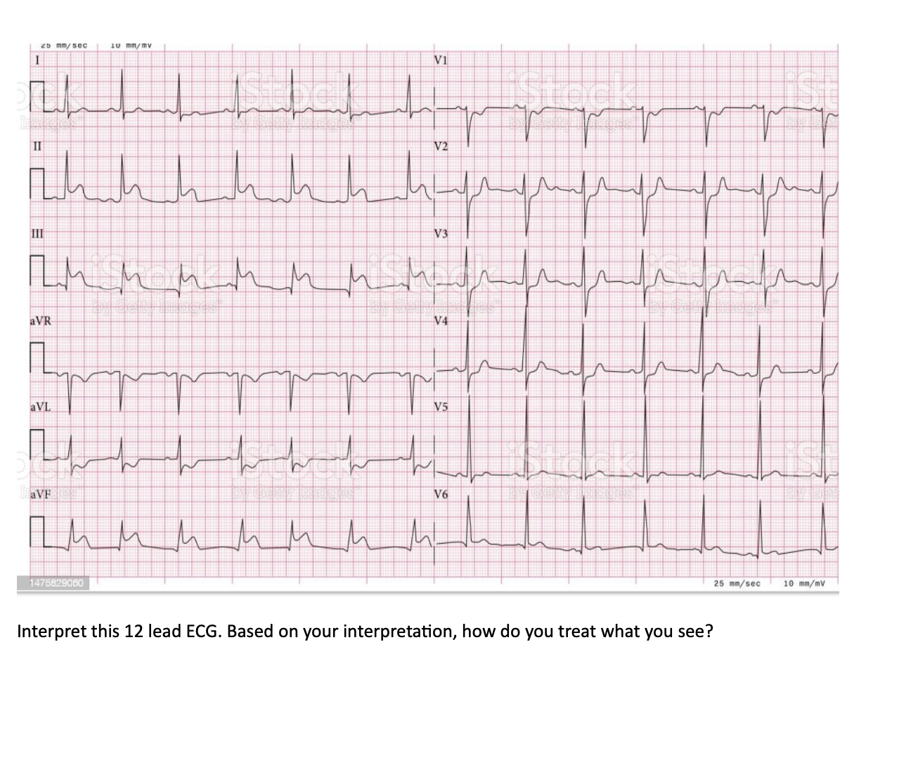 Interpret this 12 lead ECG. Based on your | Chegg.com