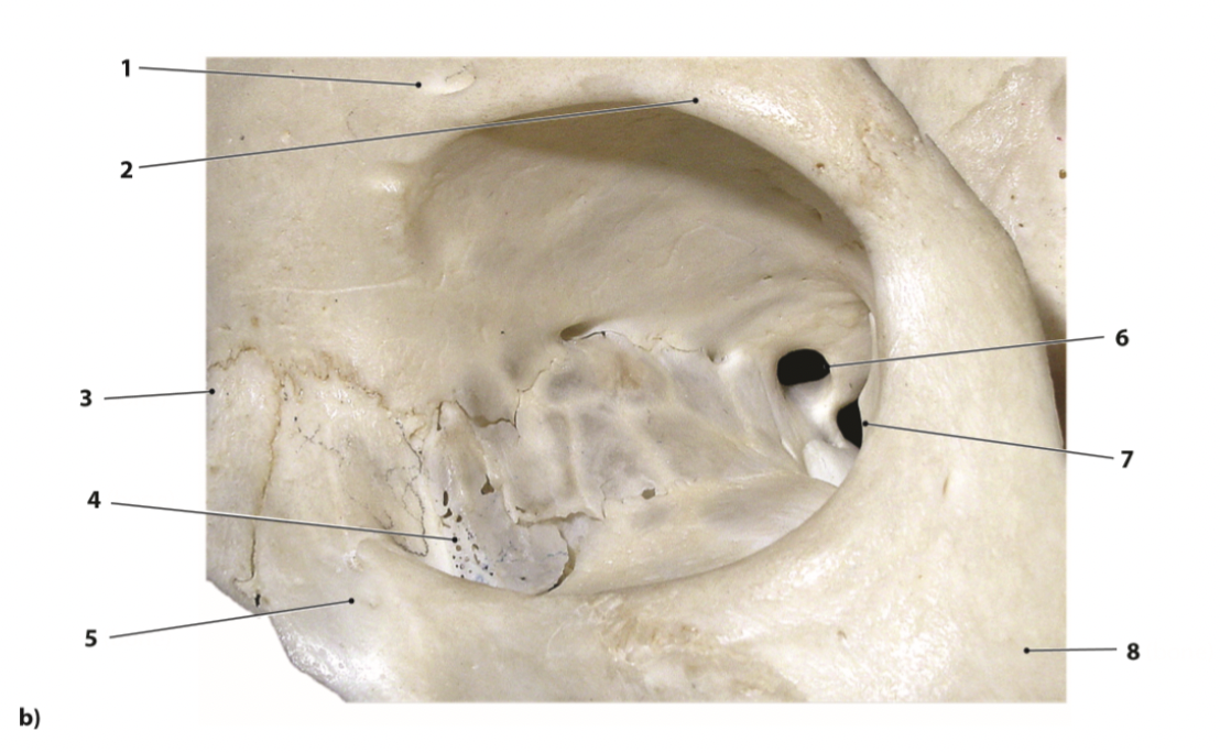 Solved b 1 Supraorbital fissure 2 Nasal bone 3 Zygomatic | Chegg.com