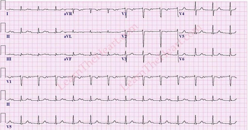 Solved Indicate the abnormalities you see (i.e., ST segment | Chegg.com