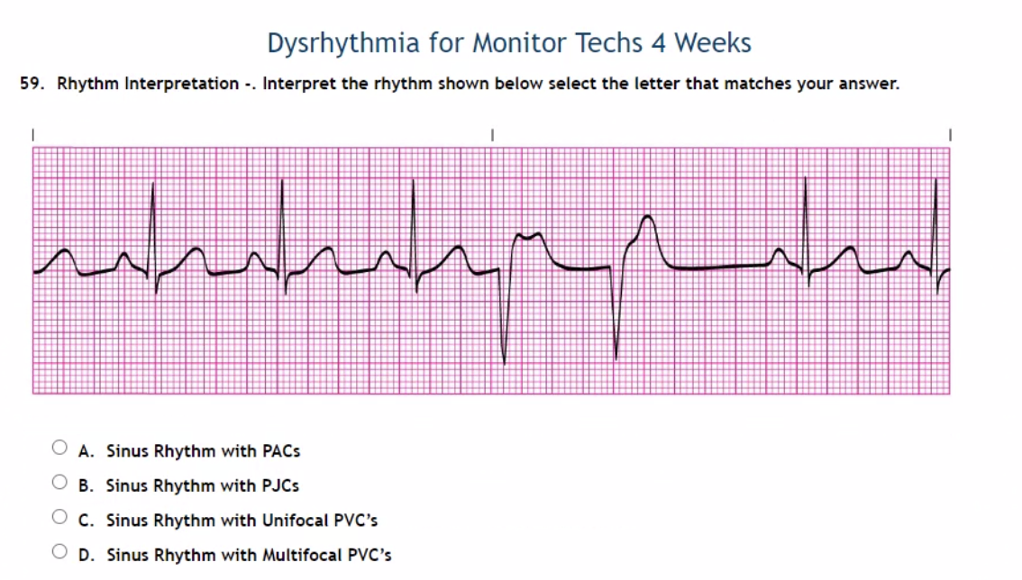 Solved Dysrhythmia for Monitor Techs 4 Weeks 59. Rhythm | Chegg.com