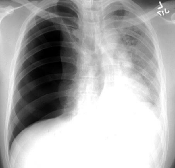 4- ﻿interpret this CXR and explain reasoning behind | Chegg.com