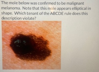 Solved The mole below was confirmed to be malignant | Chegg.com