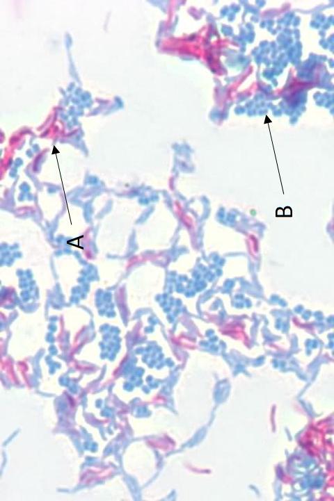 Solved What is the shape of the acid fast positive cell in | Chegg.com