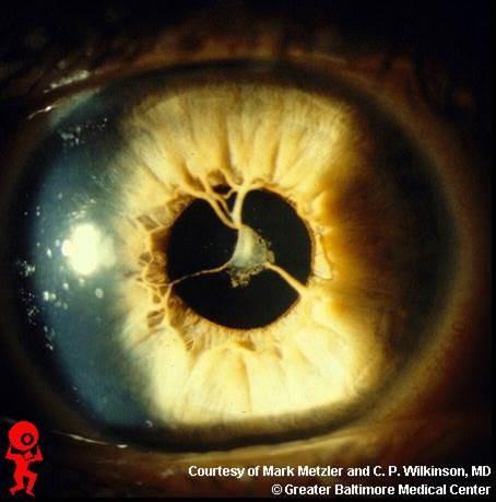 Anterior Axial Embryonic Cataract