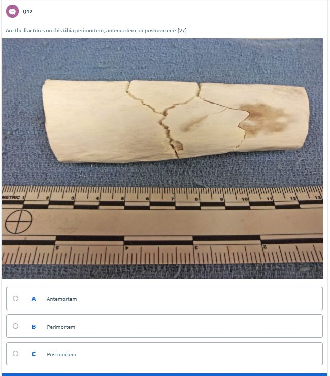 Solved 012 Are the fractures on this tibia perimortem, | Chegg.com