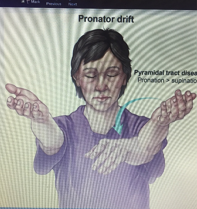 Pronator Drift Legs