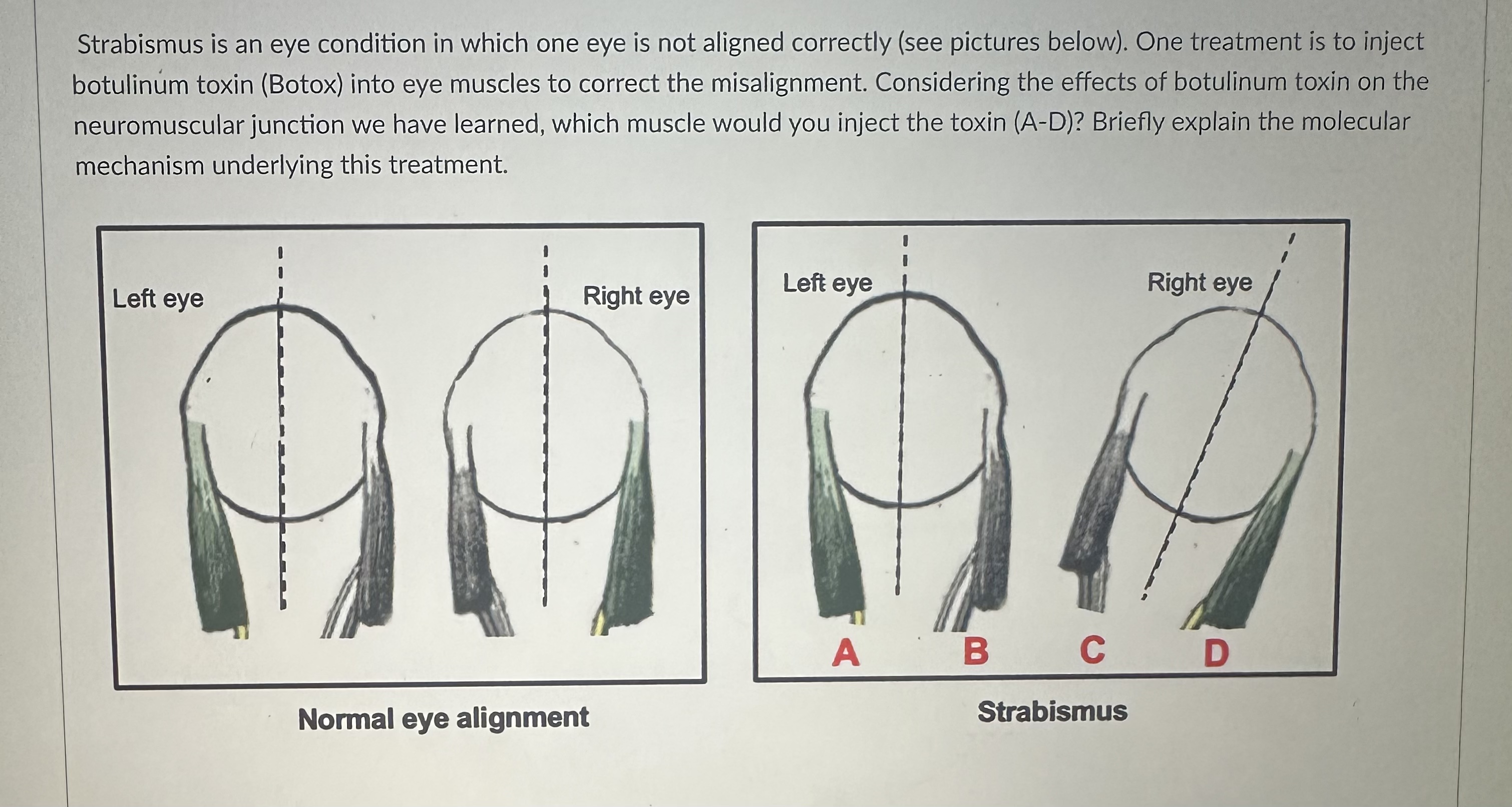 Solved Strabismus is an eye condition in which one eye is | Chegg.com