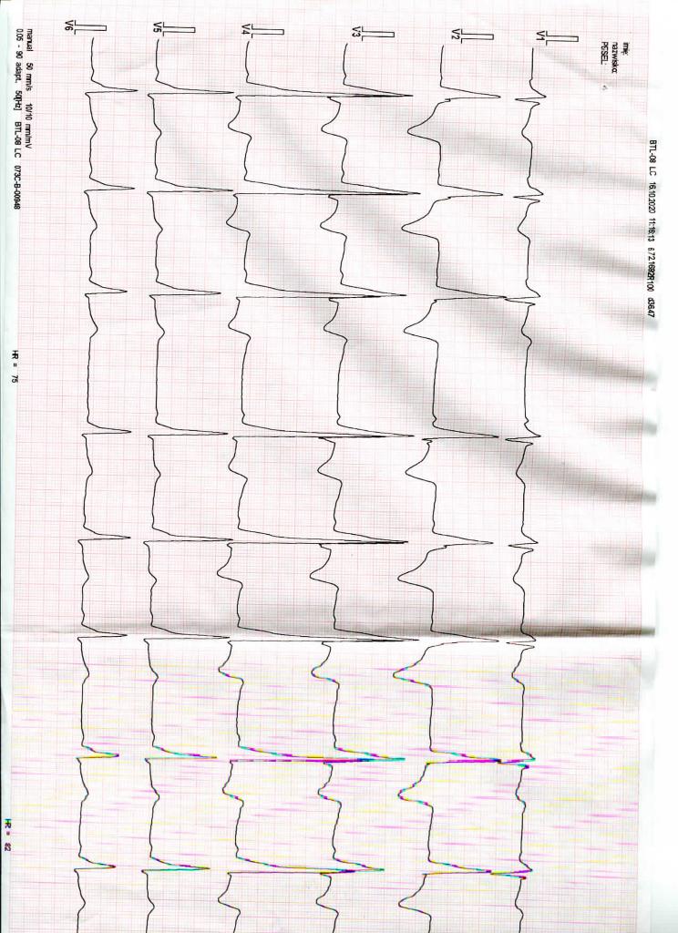 the patient 12 year old boy. Routine ECG performed | Chegg.com