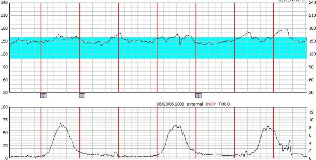 Baseline Heart Rate - Variability - Are | Chegg.com
