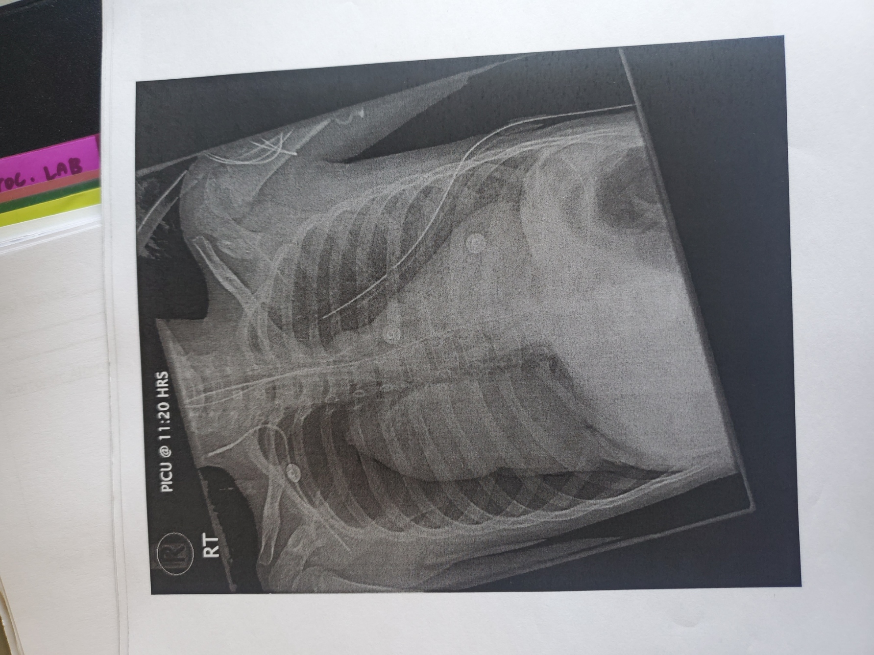 Solved 13- interpret this CXR and explain reasoning behind | Chegg.com