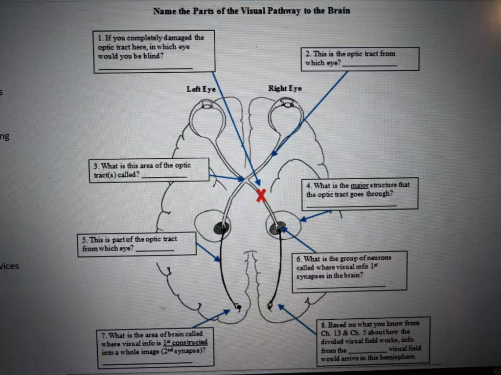 Solved 1. if you completely damaged the optic tract here, in | Chegg.com