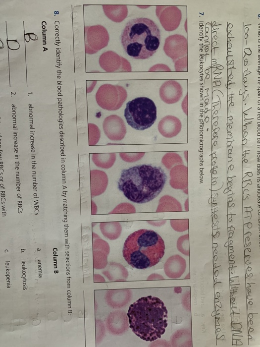 Correctly Identify the Blood Pathologies Described in Column a