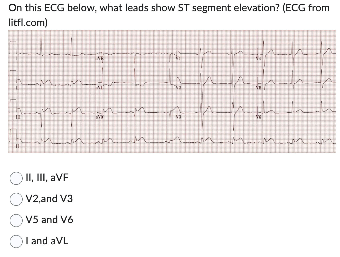 Solved On this ECG below, what leads show ST segment | Chegg.com