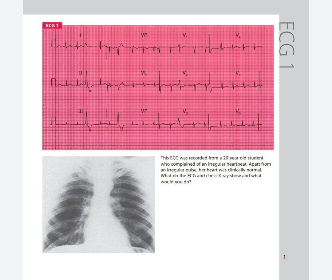 Solved ECG 1 VR V. They earch wint ECG 1 VL V V. hrichter | Chegg.com