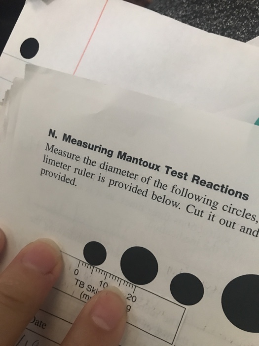 Solved Test Reactions N. Measuring Mantoux Measure the | Chegg.com