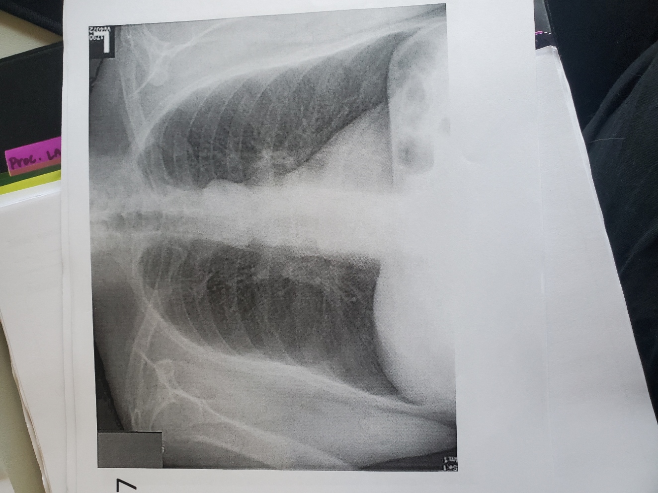 Solved 7- interpret this CXR and explain reasoning behind | Chegg.com