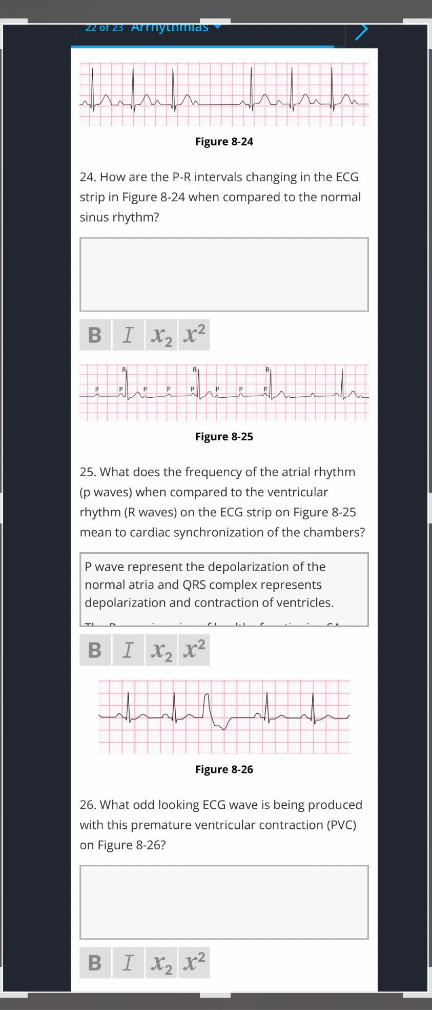 Solved 24. How are the P-R intervals changing in the ECG | Chegg.com