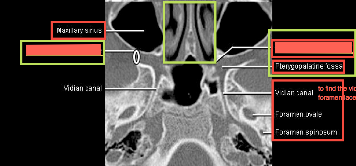 Sphenopalatine Foramen Radiology
