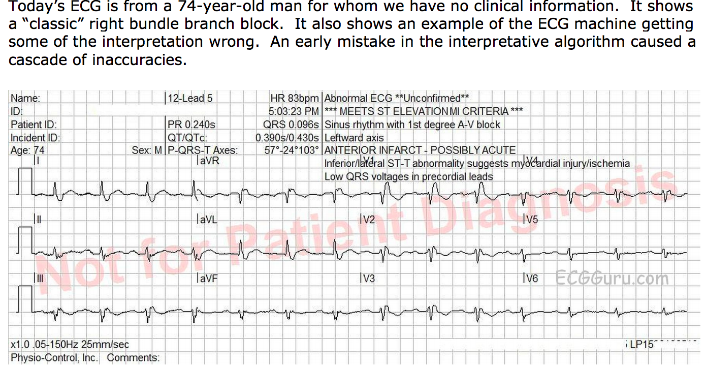 Solved MEASUREMENTS: PR Interval: QRS Interval: QT | Chegg.com