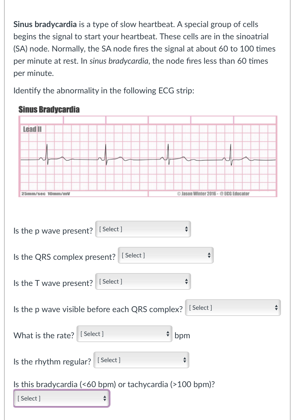 Solved Sinus bradycardia is a type of slow heartbeat. A | Chegg.com