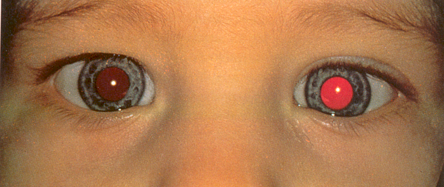 Vitreous Hemorrhage Red Reflex