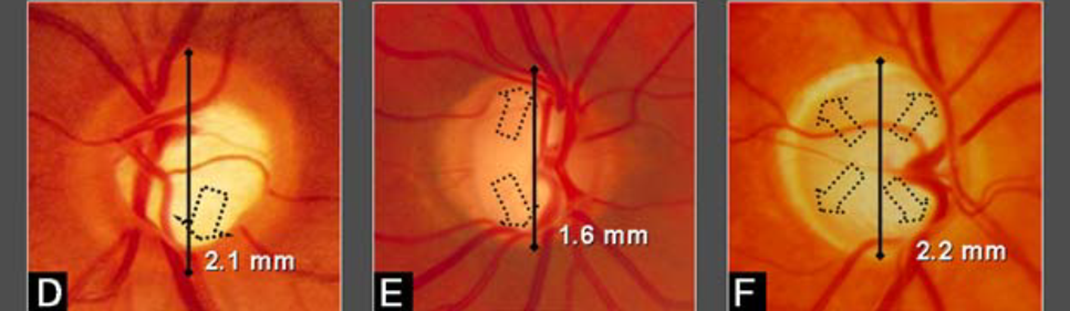 Solved For the following six images of the optic disc (a to | Chegg.com
